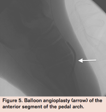 Percutaneous Revascularization of the Pedal Arch of the Foot for ...