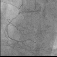 Closing an Open Zipper With the Flash Ostial Dual Balloon Angioplasty ...