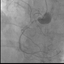 Closing an Open Zipper With the Flash Ostial Dual Balloon Angioplasty ...