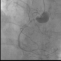 Closing an Open Zipper With the Flash Ostial Dual Balloon Angioplasty ...