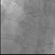Closing an Open Zipper With the Flash Ostial Dual Balloon Angioplasty ...