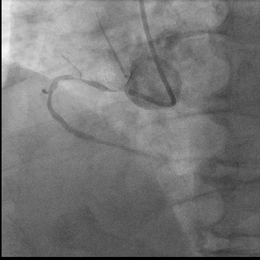 The Flash Saves the Day: A Device for Ostial Lesions