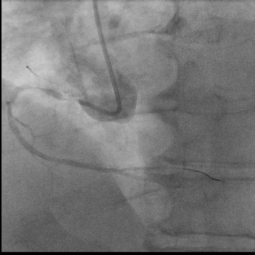 The Flash Saves the Day: A Device for Ostial Lesions