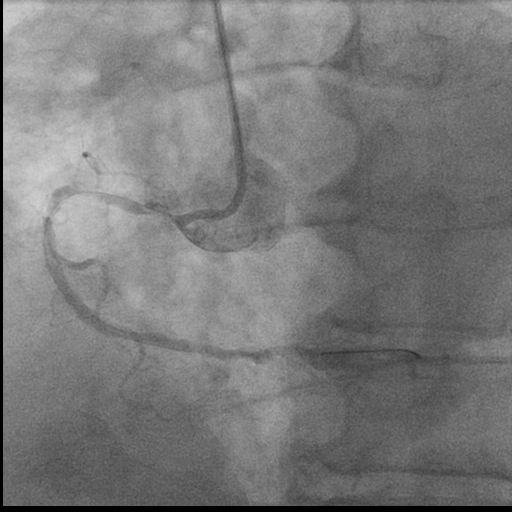 The Flash Saves the Day: A Device for Ostial Lesions