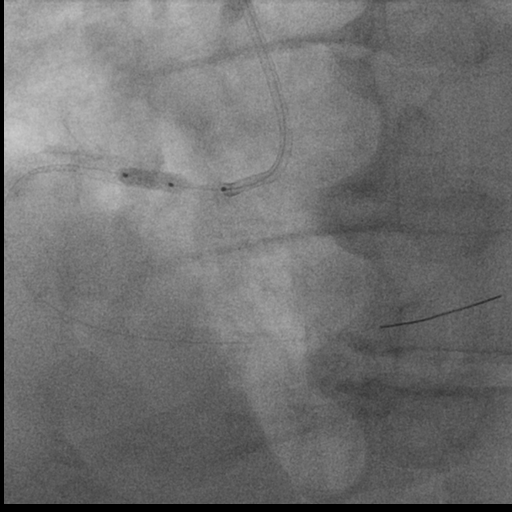 The Flash Saves the Day: A Device for Ostial Lesions