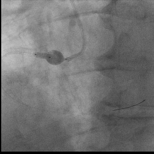The Flash Saves the Day: A Device for Ostial Lesions