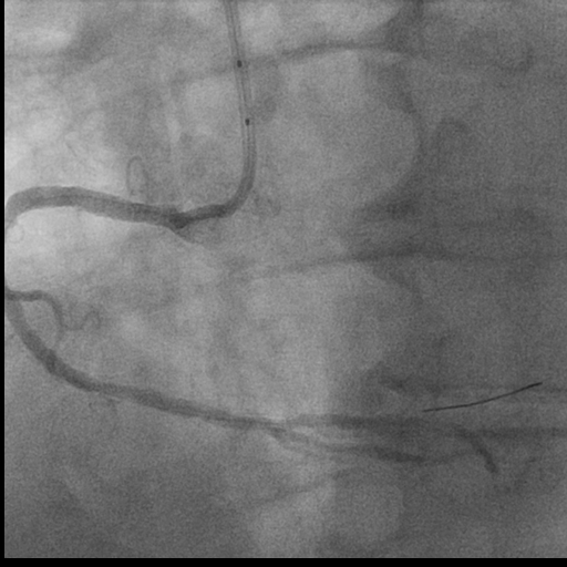 The Flash Saves the Day: A Device for Ostial Lesions