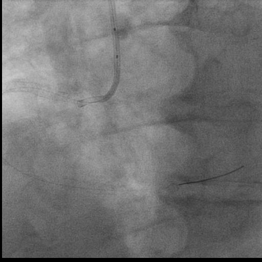 The Flash Saves the Day: A Device for Ostial Lesions