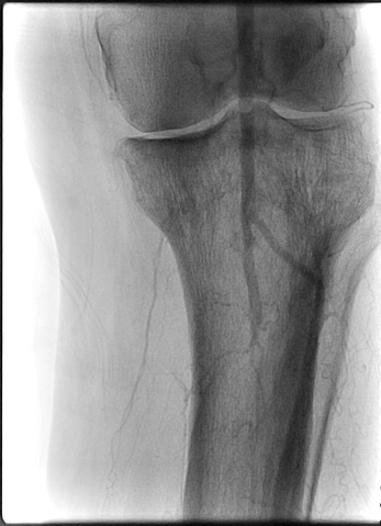 Tibiopedal Access: Safe and Underutilized