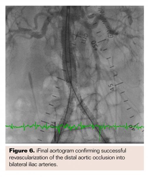 Aortoiliac Occlusive Disease Revascularization Utilizing Crossing With ...