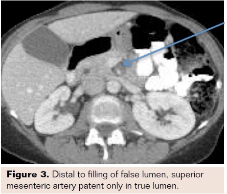 Successful Nonoperative Management of Isolated Superior Mesenteric ...