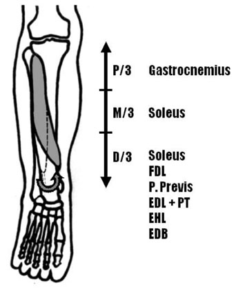 Use of Single or Double Local Muscle Flap Transfers for Coverage of ...