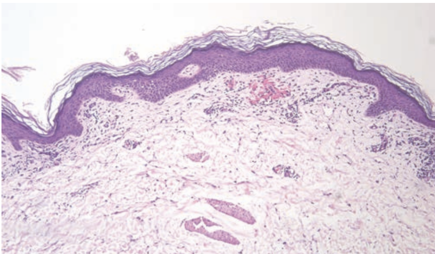 What Is This Hyperpigmented Annular Axillary Rash?