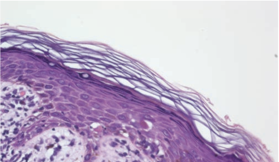 What Is This Hyperpigmented Annular Axillary Rash?