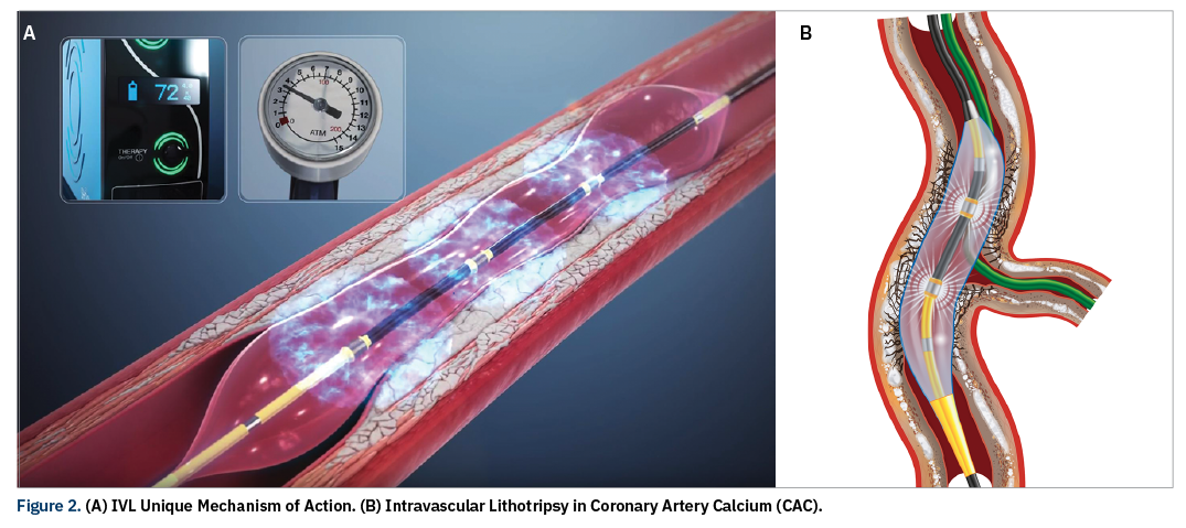 The Impact of Calcium on PCI and the Need for Intravascular Lithotripsy ...
