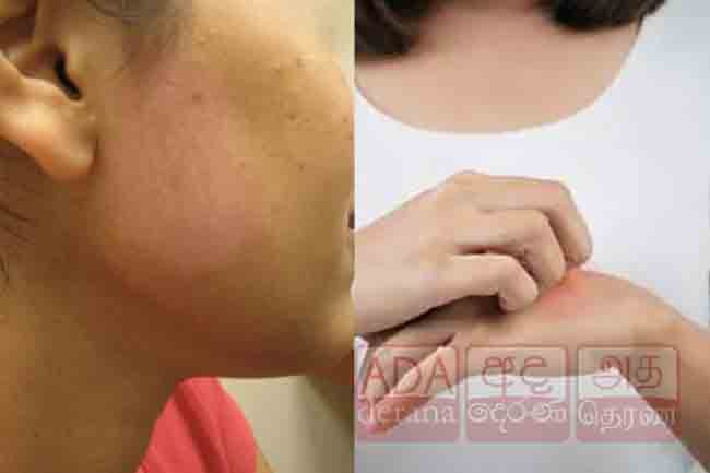 මෙවැනි ලප කැළැල් දුටුවොත් සැලකිලිමත්වන්න