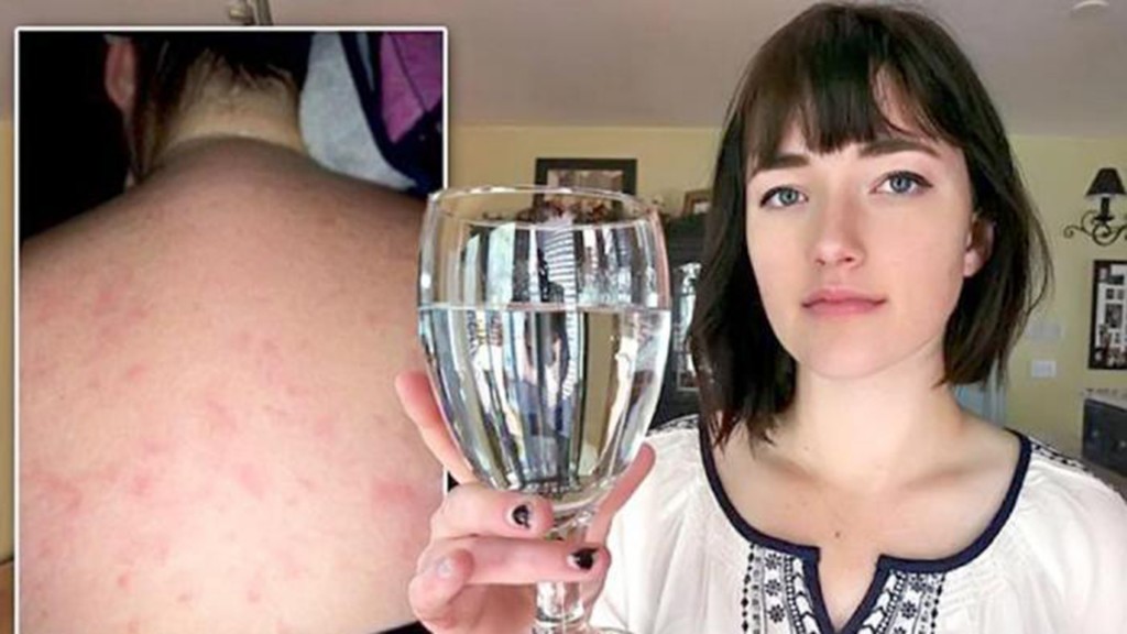 Alergia Al Agua Cómo Es La Difícil Vida De Los Que No Pueden Llorar
