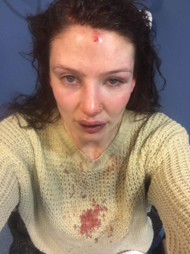 Un Jugador De Cricket Golpeó Sin Piedad A Su Pareja Y Ella Publicó Las Espeluznantes Fotos No
