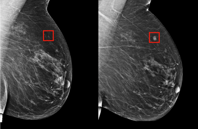 El Mit Desarrolló Un Método Para Identificar El Cáncer De Mama Con 8513