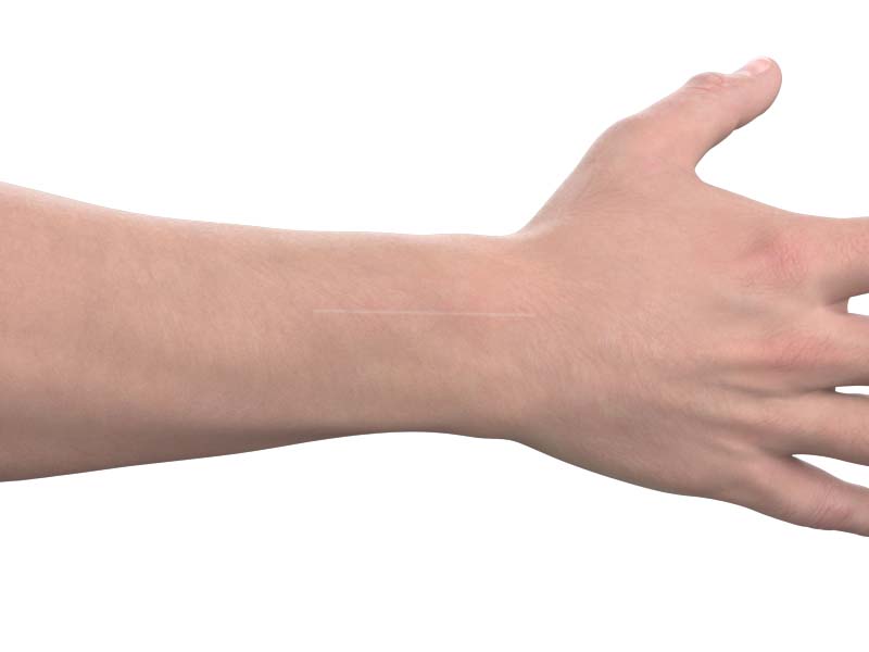 Scaphoid Fracture Surgery Scar