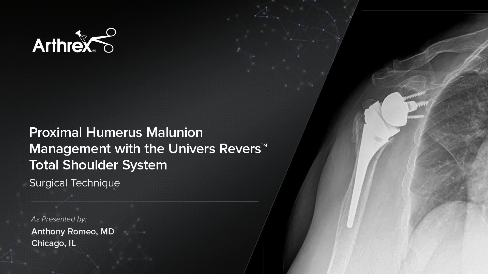 Arthrex - Proximal Humerus Malunion Management with the Univers Revers ...