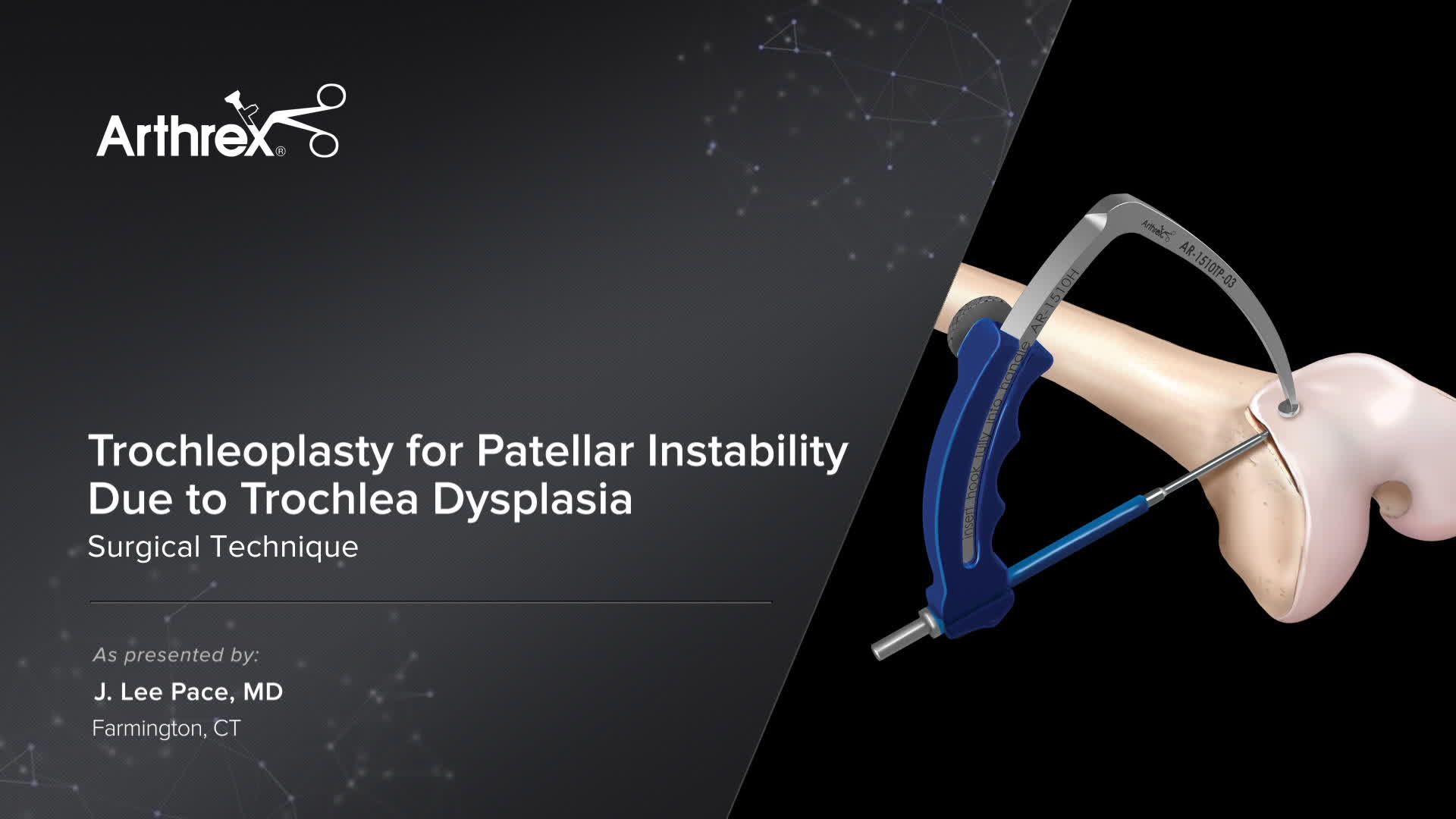 Arthrex - Trochleoplasty for Patellar Instability Due to Trochlea Dysplasia