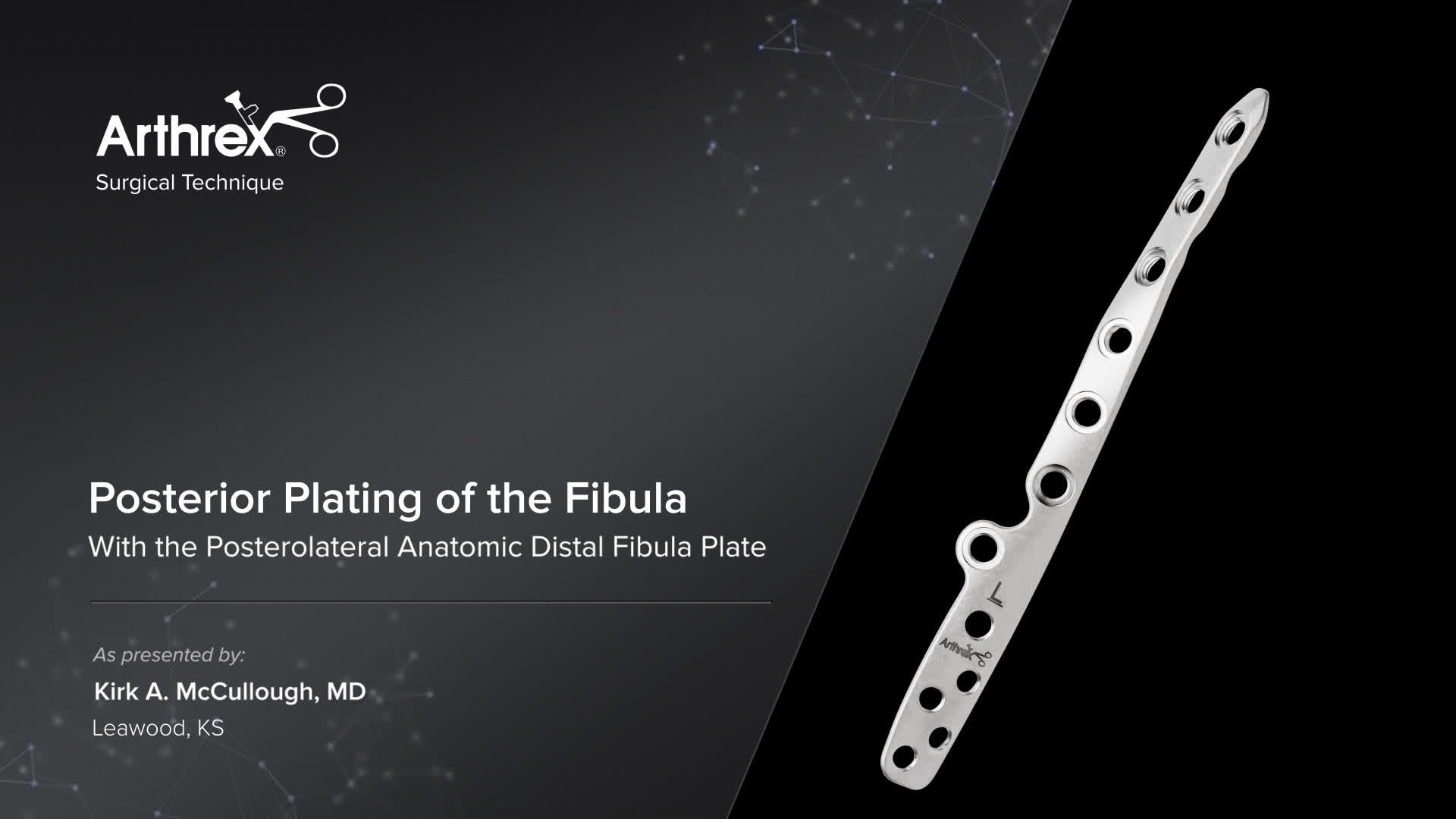 Arthrex - Posterior Plating of the Fibula With the Posterolateral ...