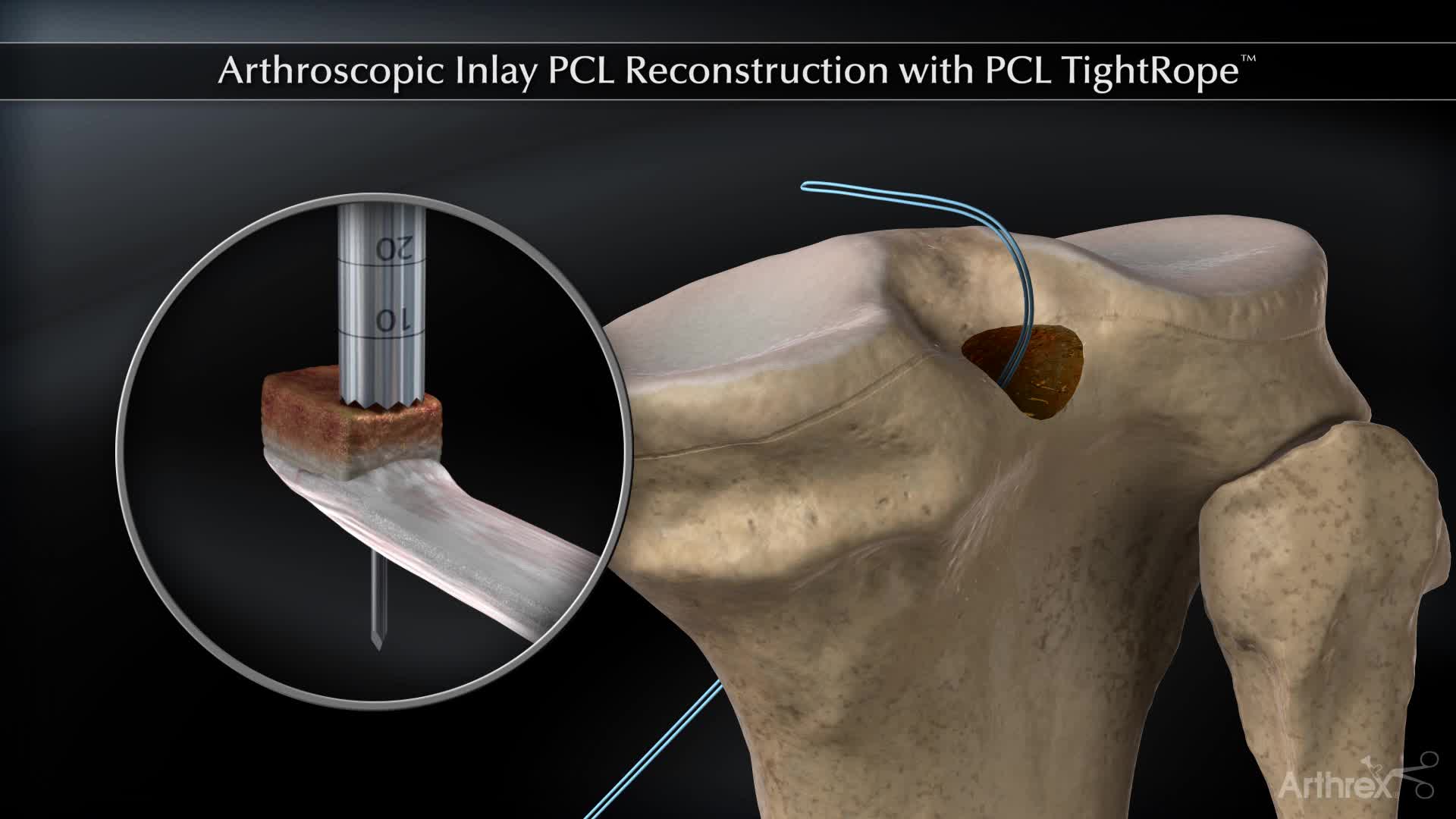 Arthrex - Arthroscopic Inlay PCL Reconstruction with PCL TightRope®