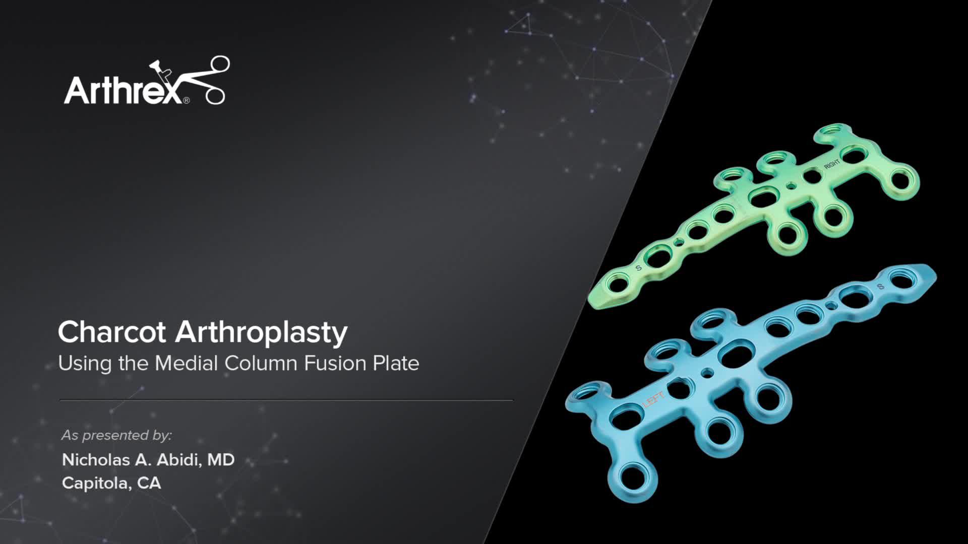 Arthrex - Charcot Arthroplasty Using the Medial Column Fusion Plate
