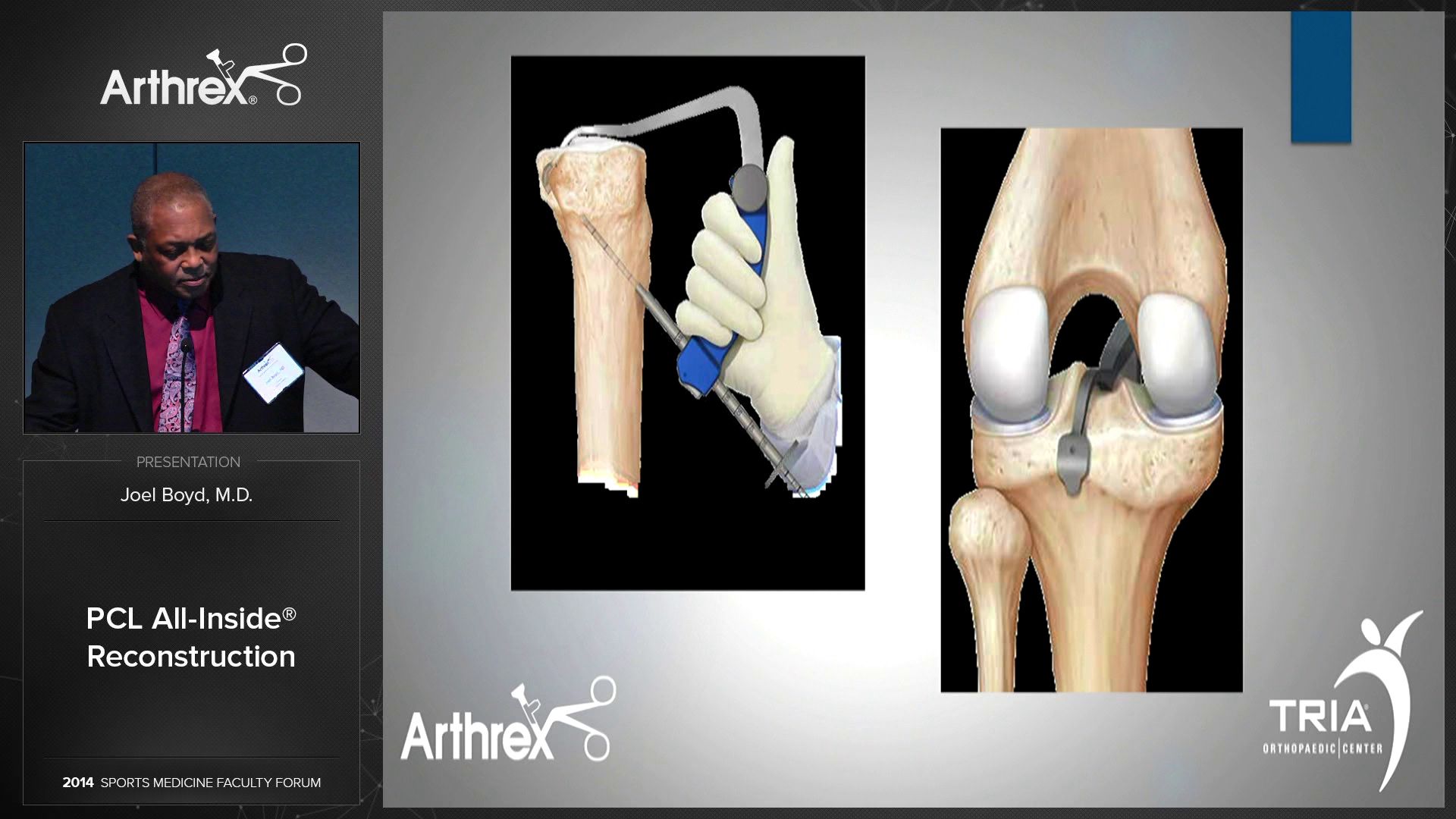 Arthrex - PCL All-Inside Reconstruction