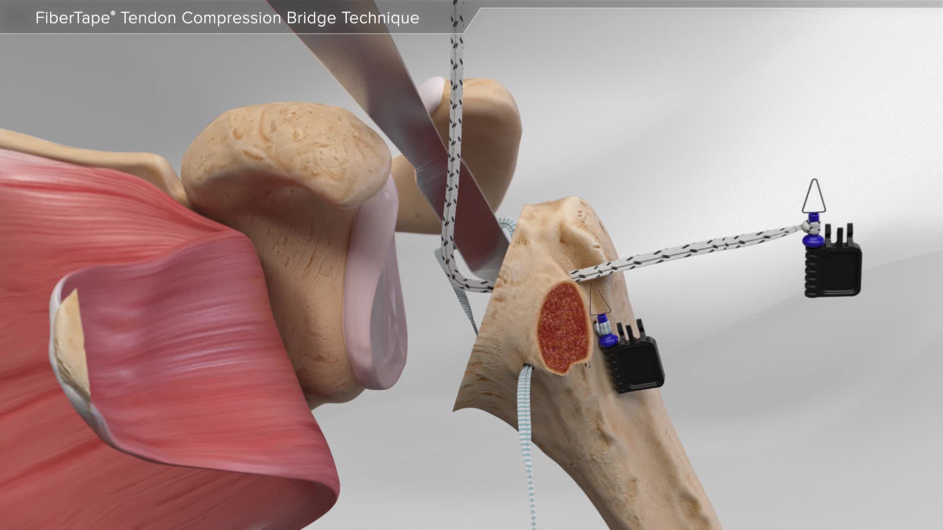 Arthrex - FiberTape® Tendon Compression Bridge Technique