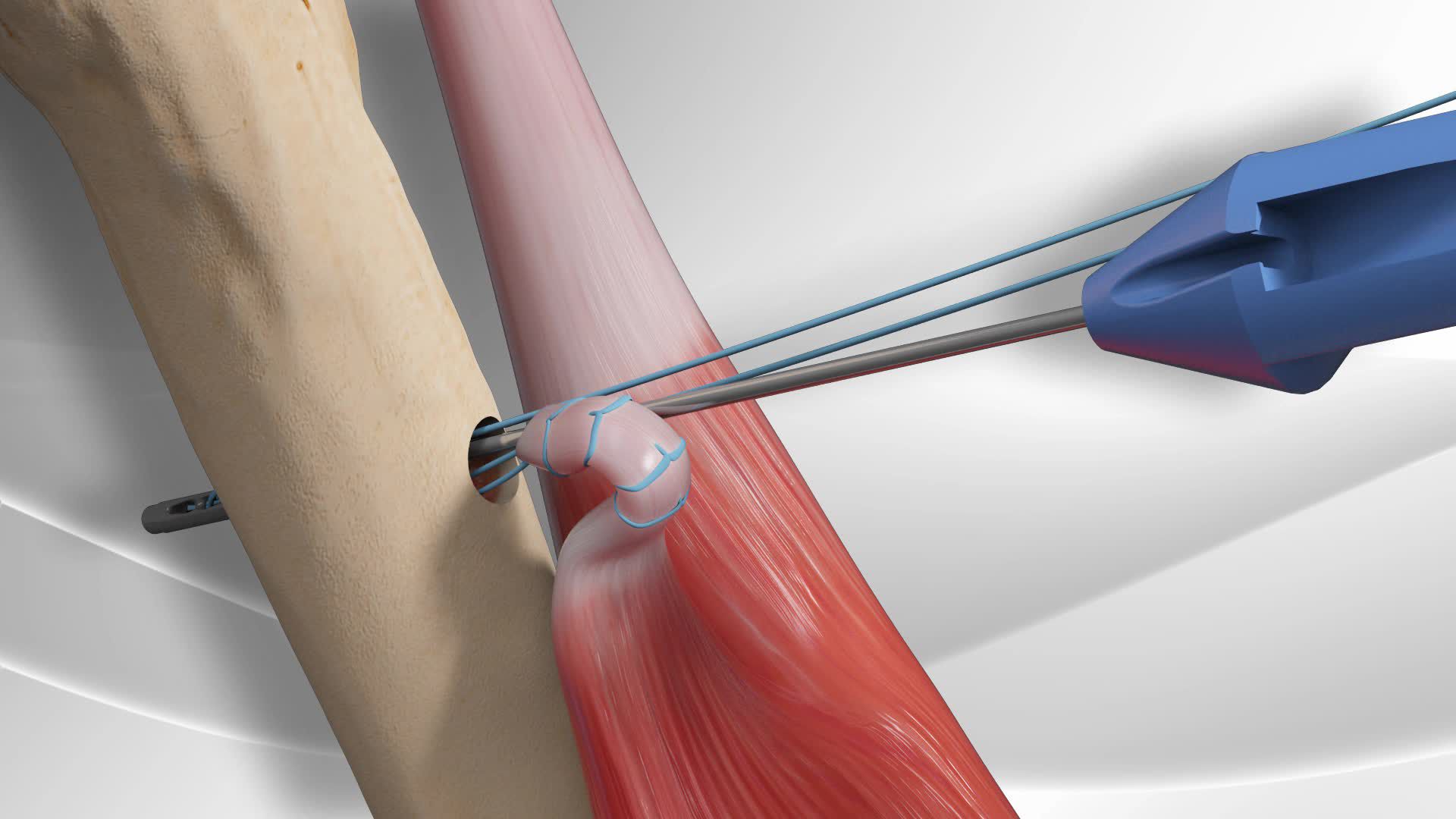 Arthrex - Biceps Tenodesis with BicepsButton™ Kit