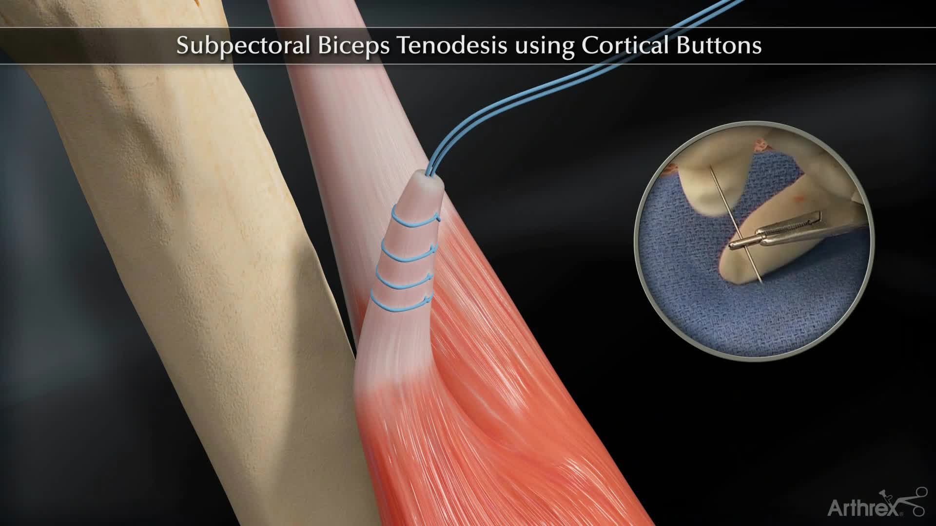 Arthrex - Subpectoral Biceps Tenodesis Using Cortical Buttons