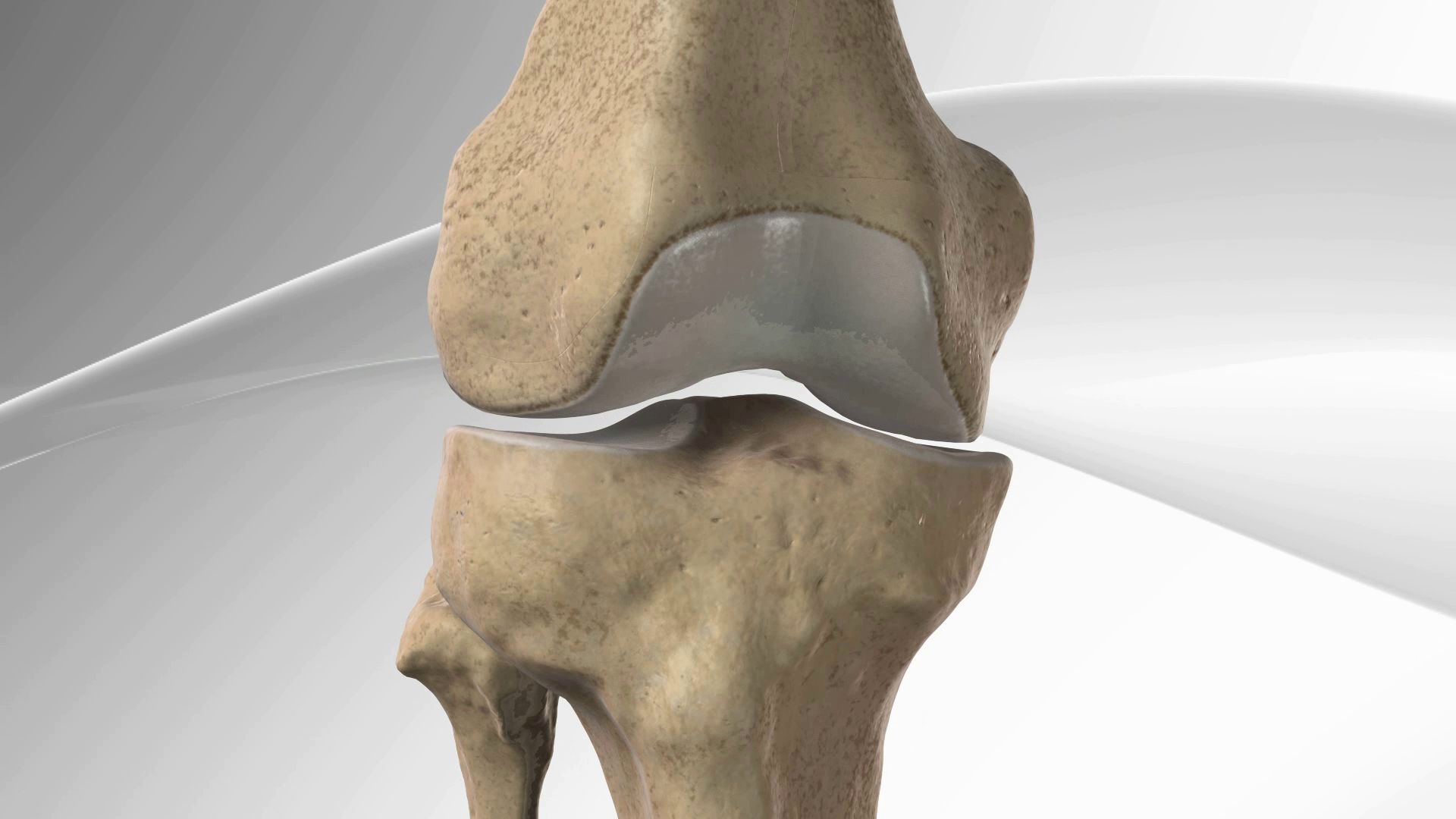 Arthrex - Inlay PCL Reconstruction with PCL TightRope® Technique