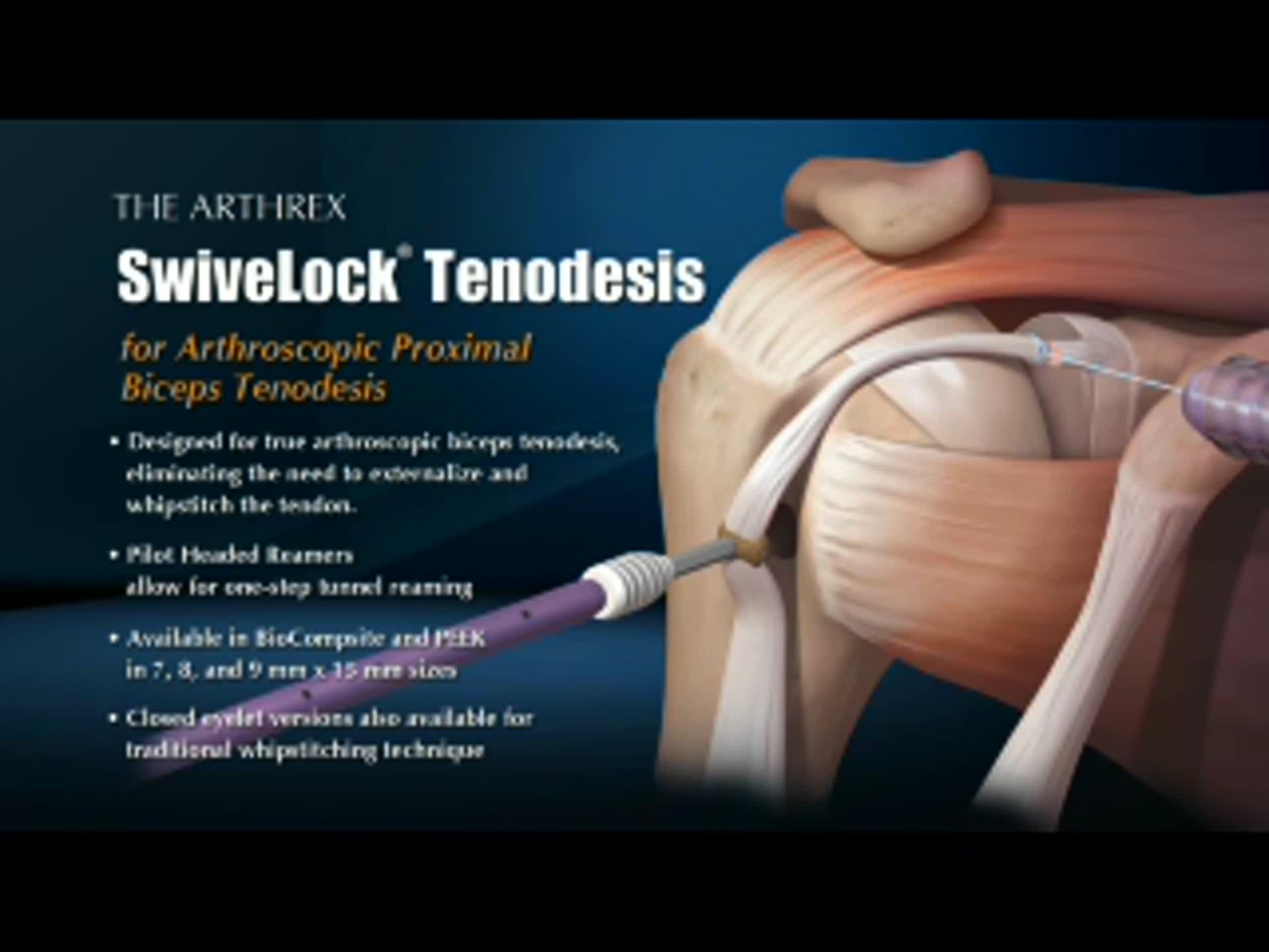Biceps Tenodesis