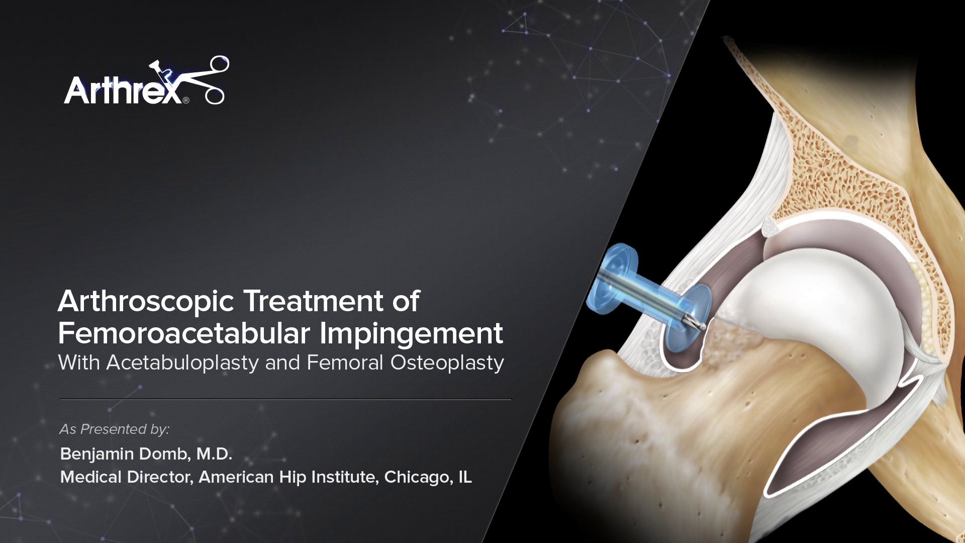 Arthrex - Treating FAI Surgical Technique