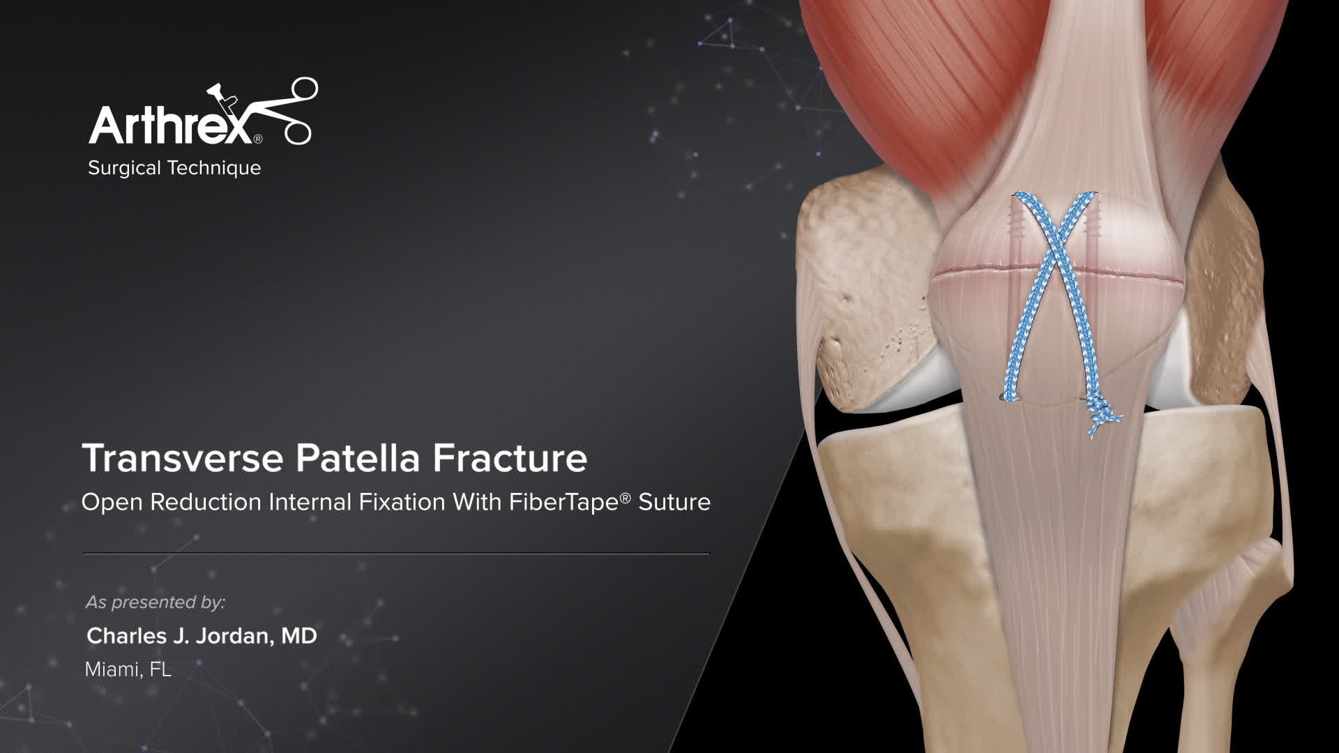 Arthrex - Transverse Patella Fracture Open Reduction Internal Fixation ...