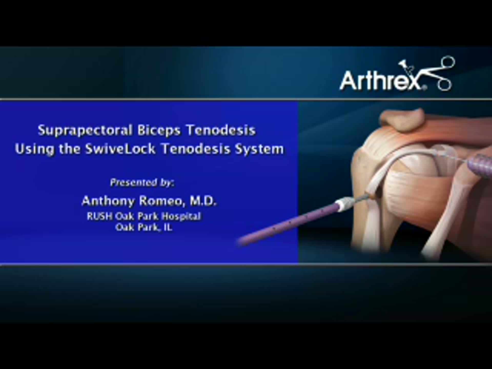 Arthrex - Suprapectoral Biceps Tenodesis Using the SwiveLock Tenodesis ...