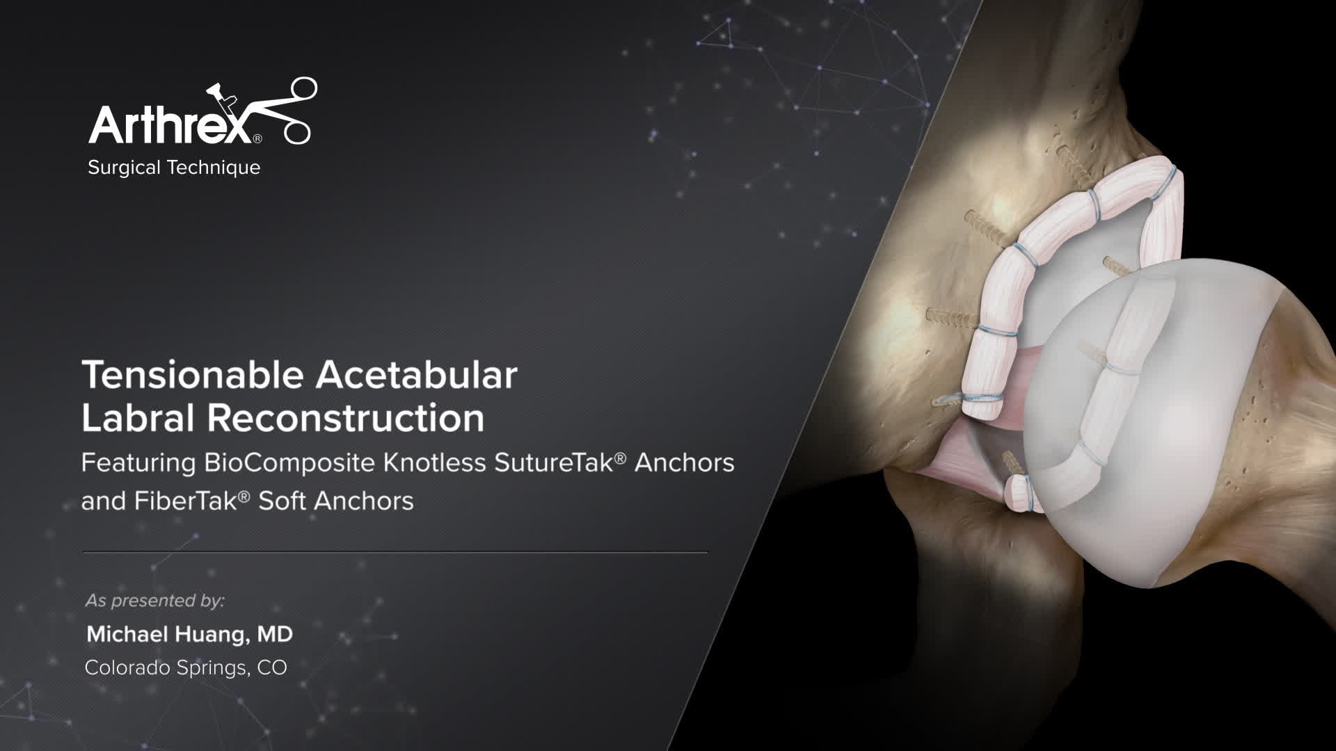 Arthrex - Tensionable Acetabular Labral Reconstruction Featuring ...