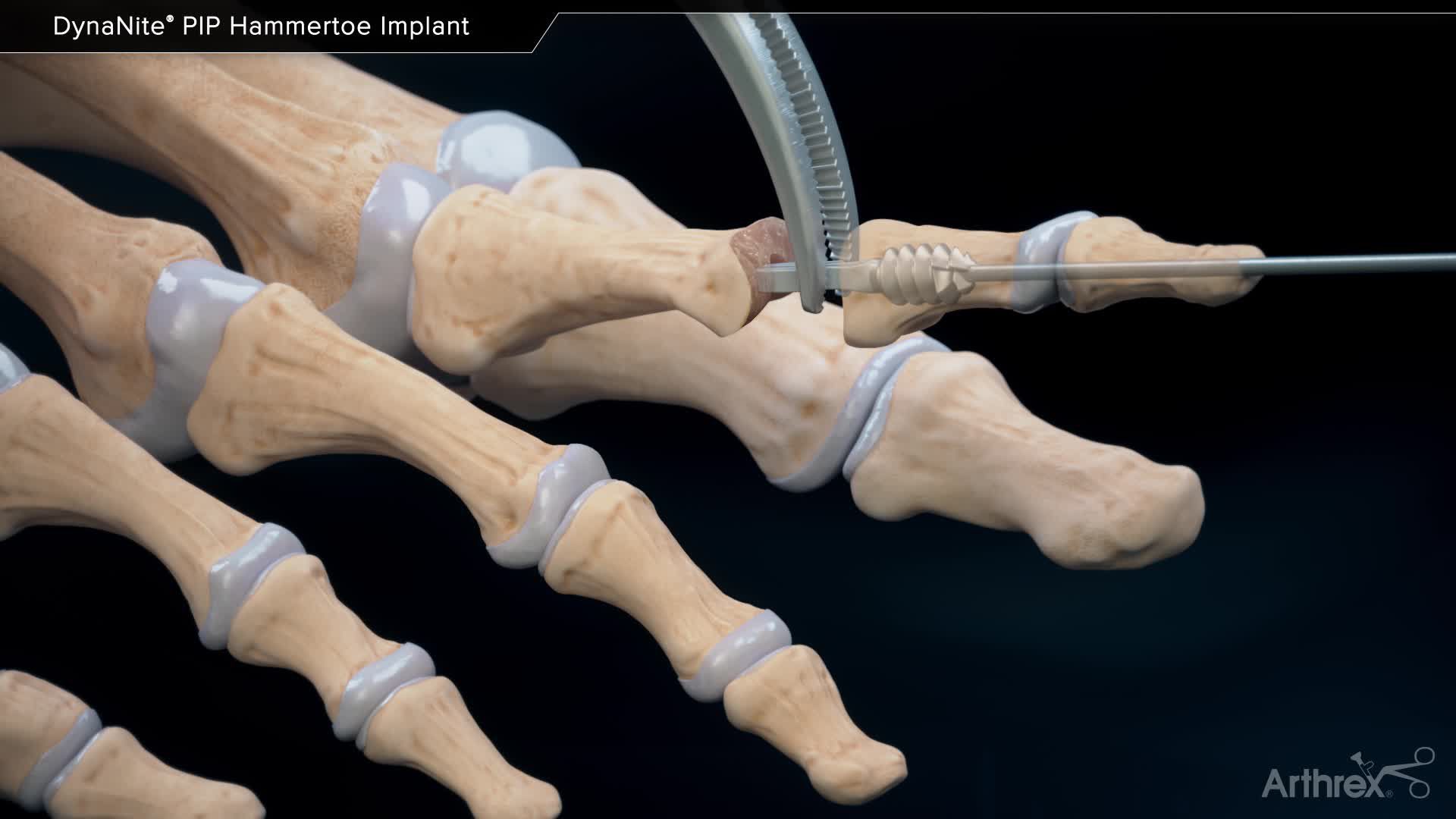 Arthrex - DynaNite® PIP Hammertoe Implant