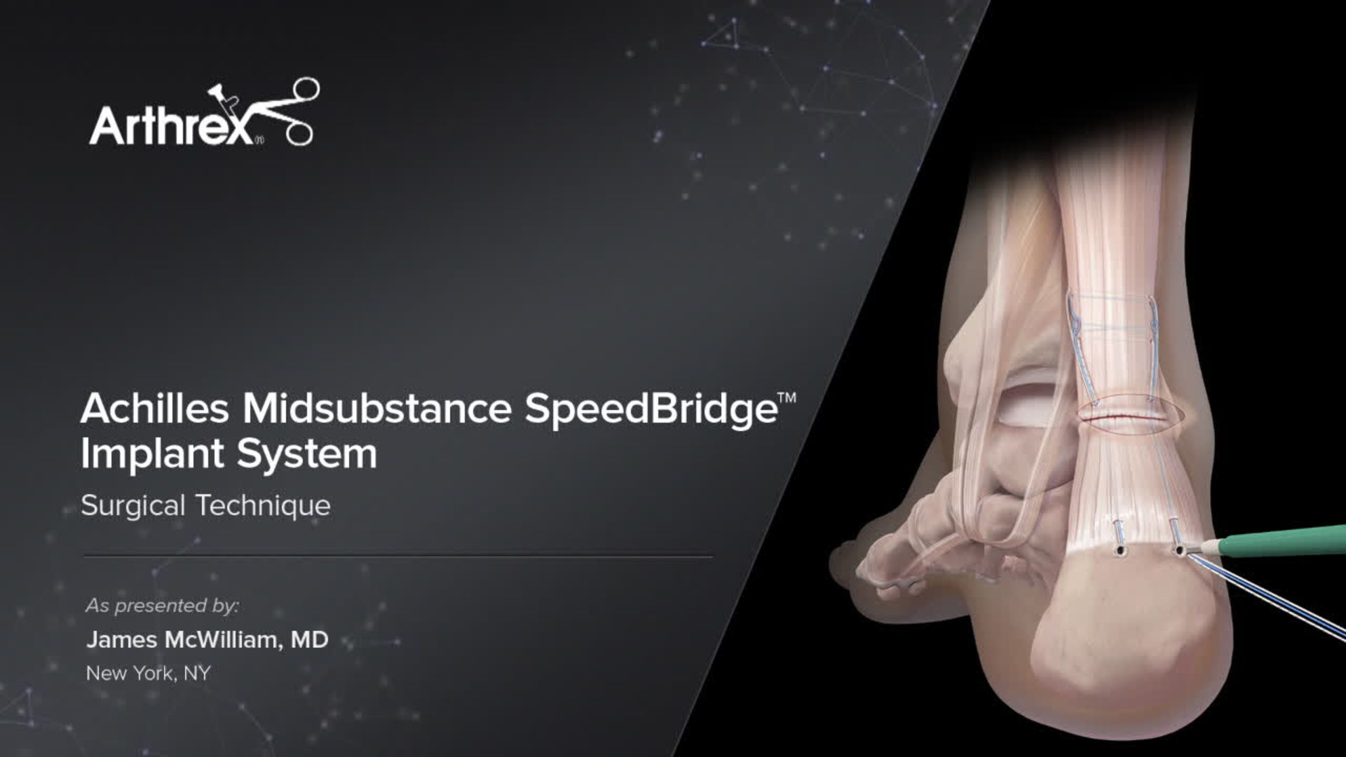 Arthrex - Achilles Midsubstance SpeedBridge™ Implant System