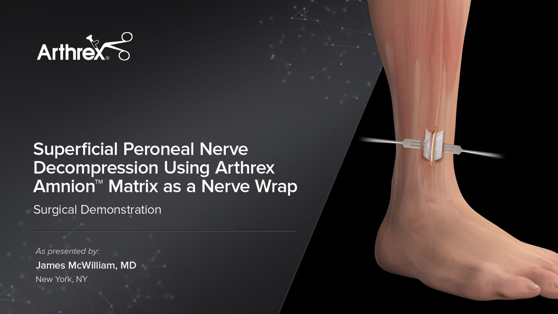 Arthrex - Superficial Peroneal Nerve Decompression Using Arthrex Amnion ...