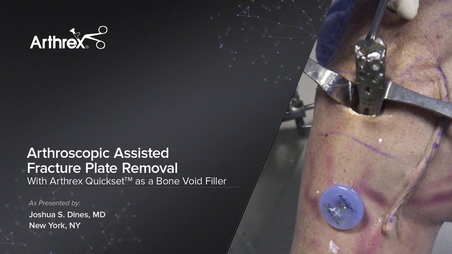 Arthrex - Arthroscopic Assisted Fracture Plate Removal With Arthrex ...