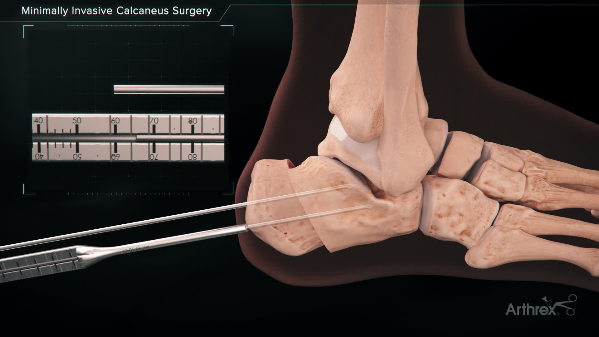 Arthrex - Minimally Invasive Calcaneus Surgery