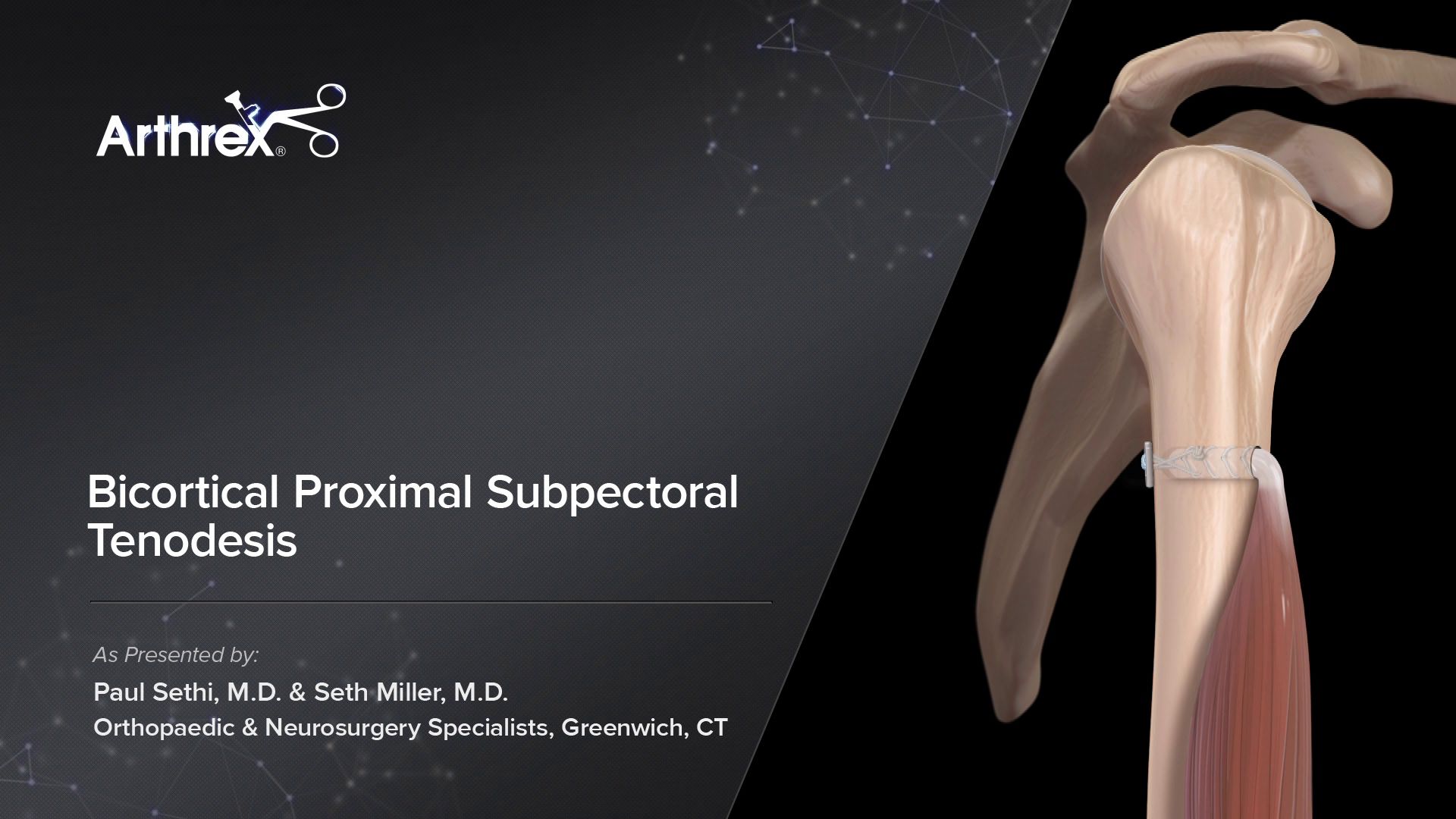 Arthrex - Bicortical Proximal Subpectoral Tenodesis