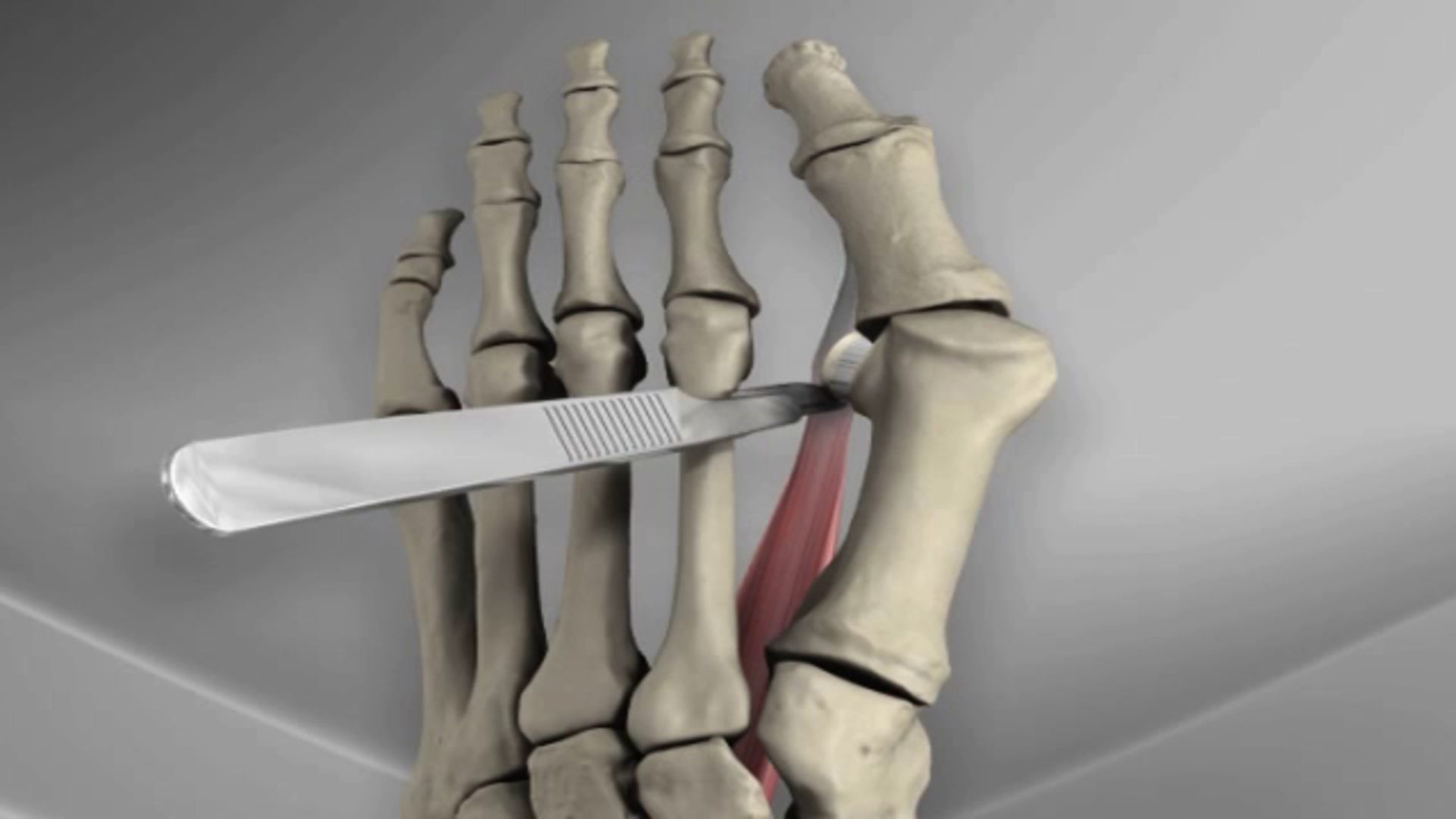 Arthrex - Técnica de Chevron distal