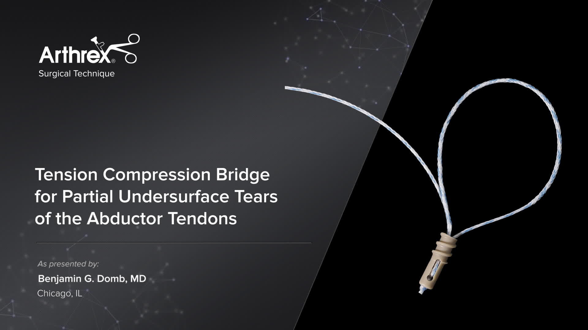 Arthrex - Tension Compression Bridge for Partial Undersurface Tears of ...