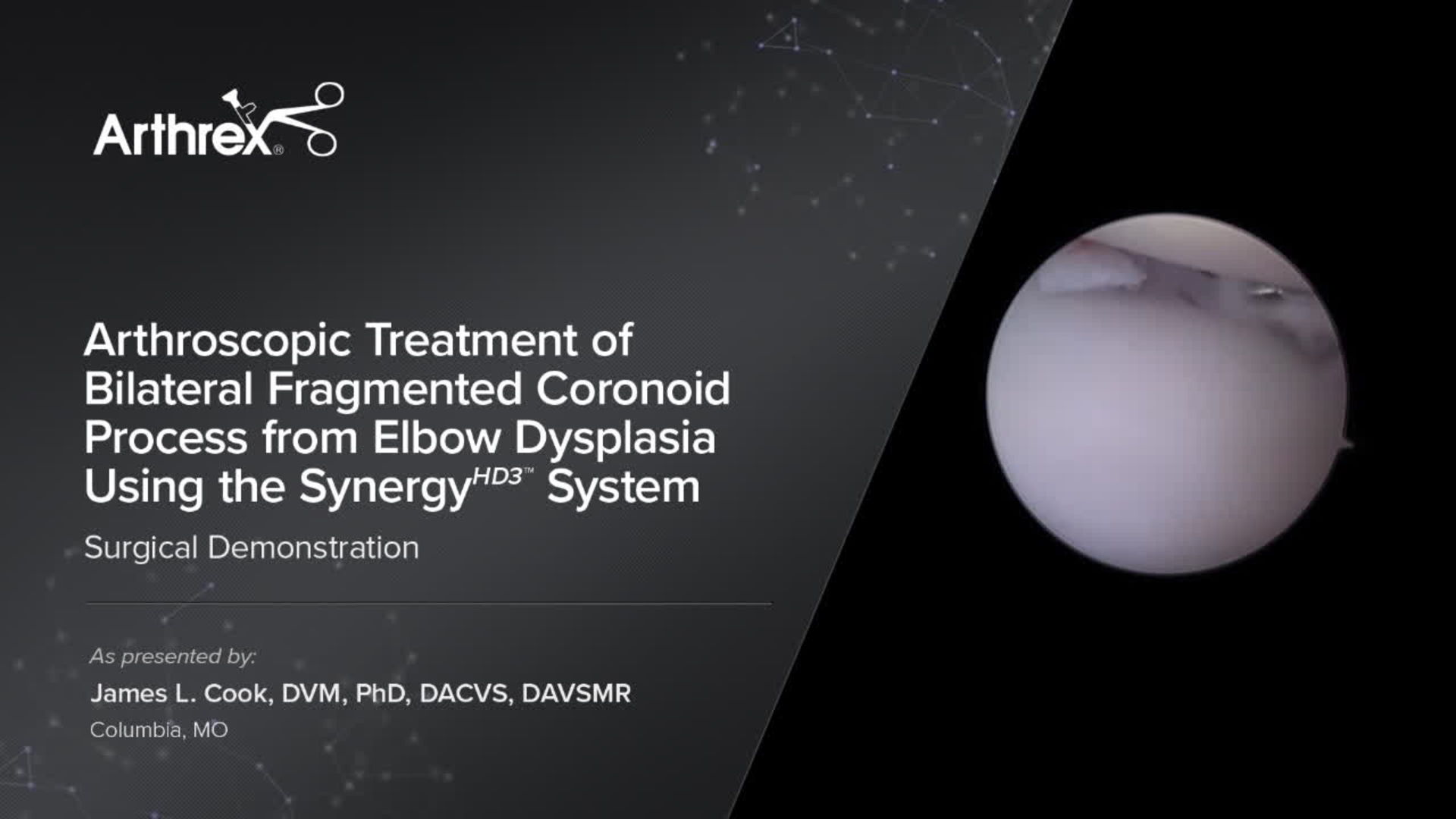 Arthrex - Arthroscopic Treatment of Bilateral Fragmented Coronoid ...