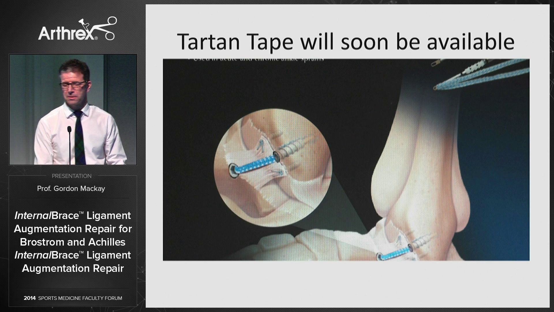 Arthrex - InternalBrace™ Ligament Augmentation Repair for Brostrom and ...