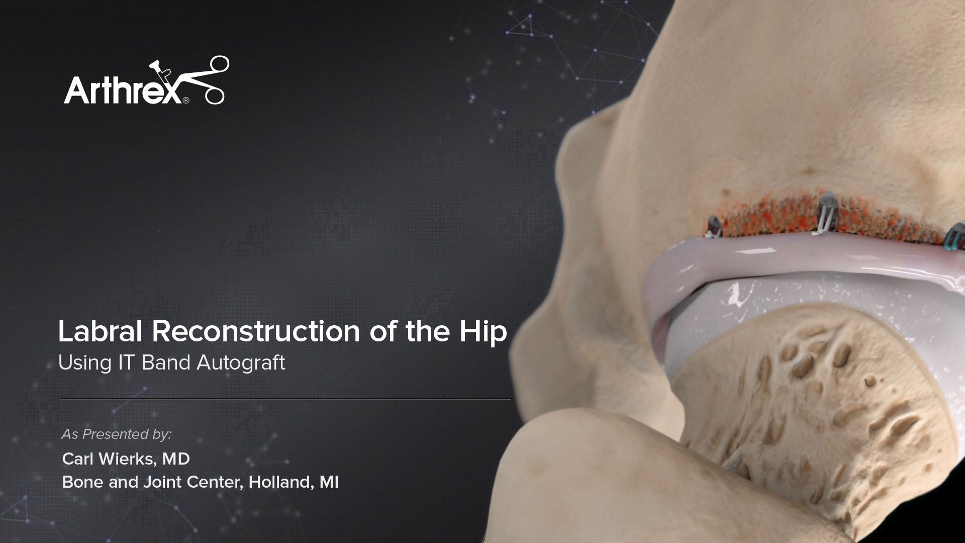 Arthrex - Labral Reconstruction of the Hip Using IT Band Autograft